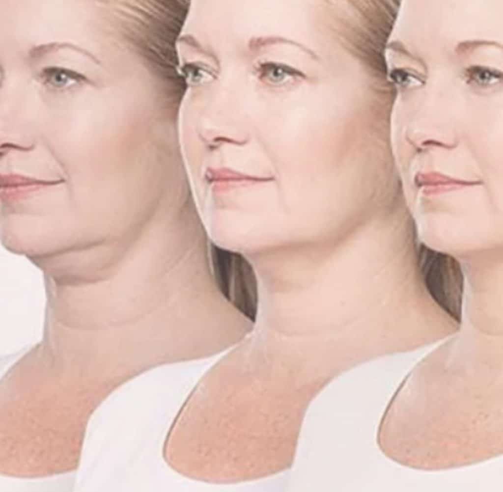 Fat Dissolving Injections - Finesse Skin Clinic