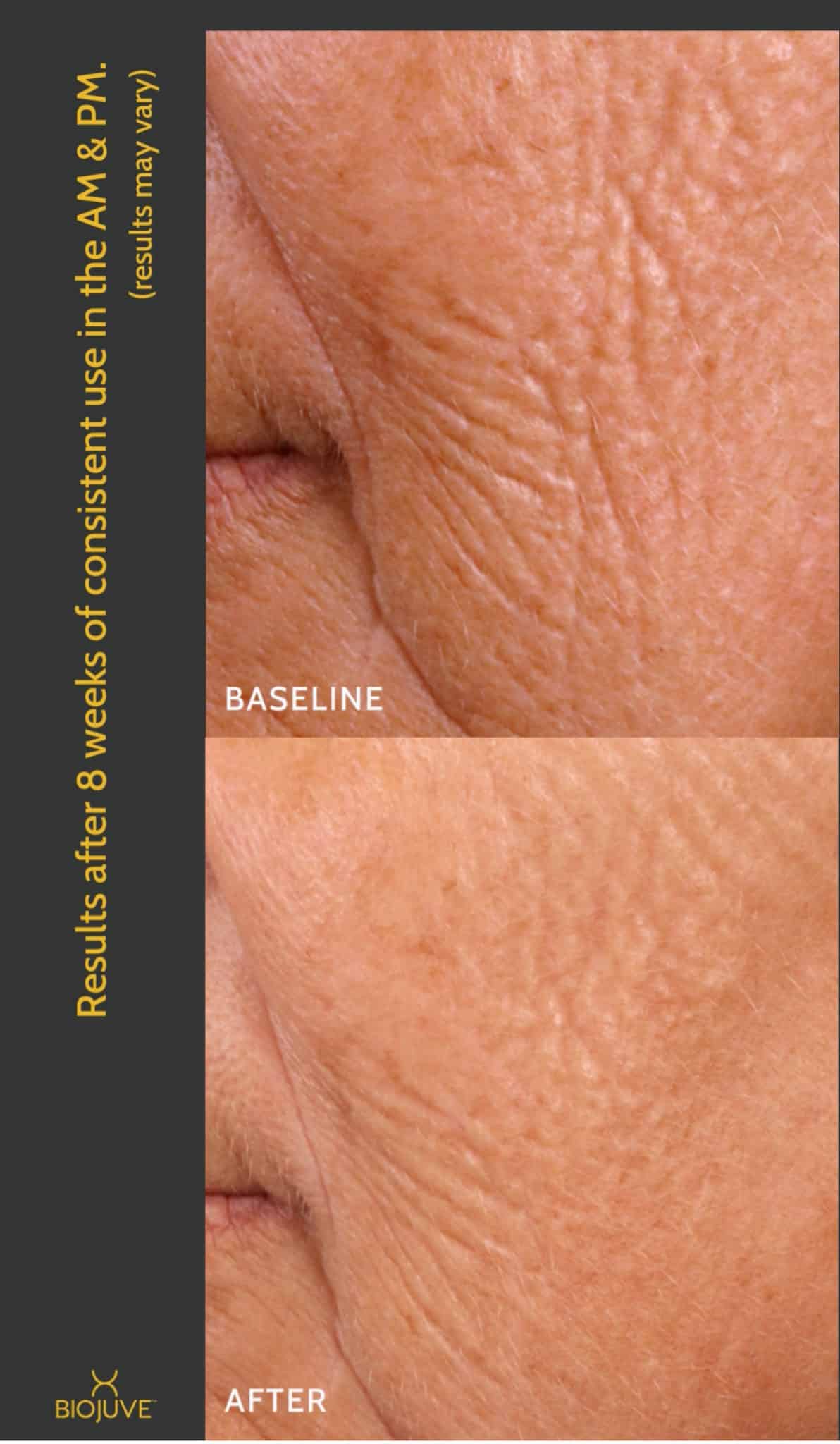 SkinPen® Precision Micro-needling - Finesse Skin Clinic