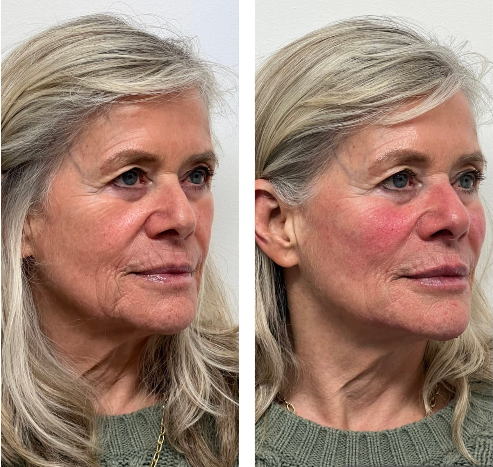 Facial Contouring Dermal Filler in Gloucester | Finesse Skin Clinic